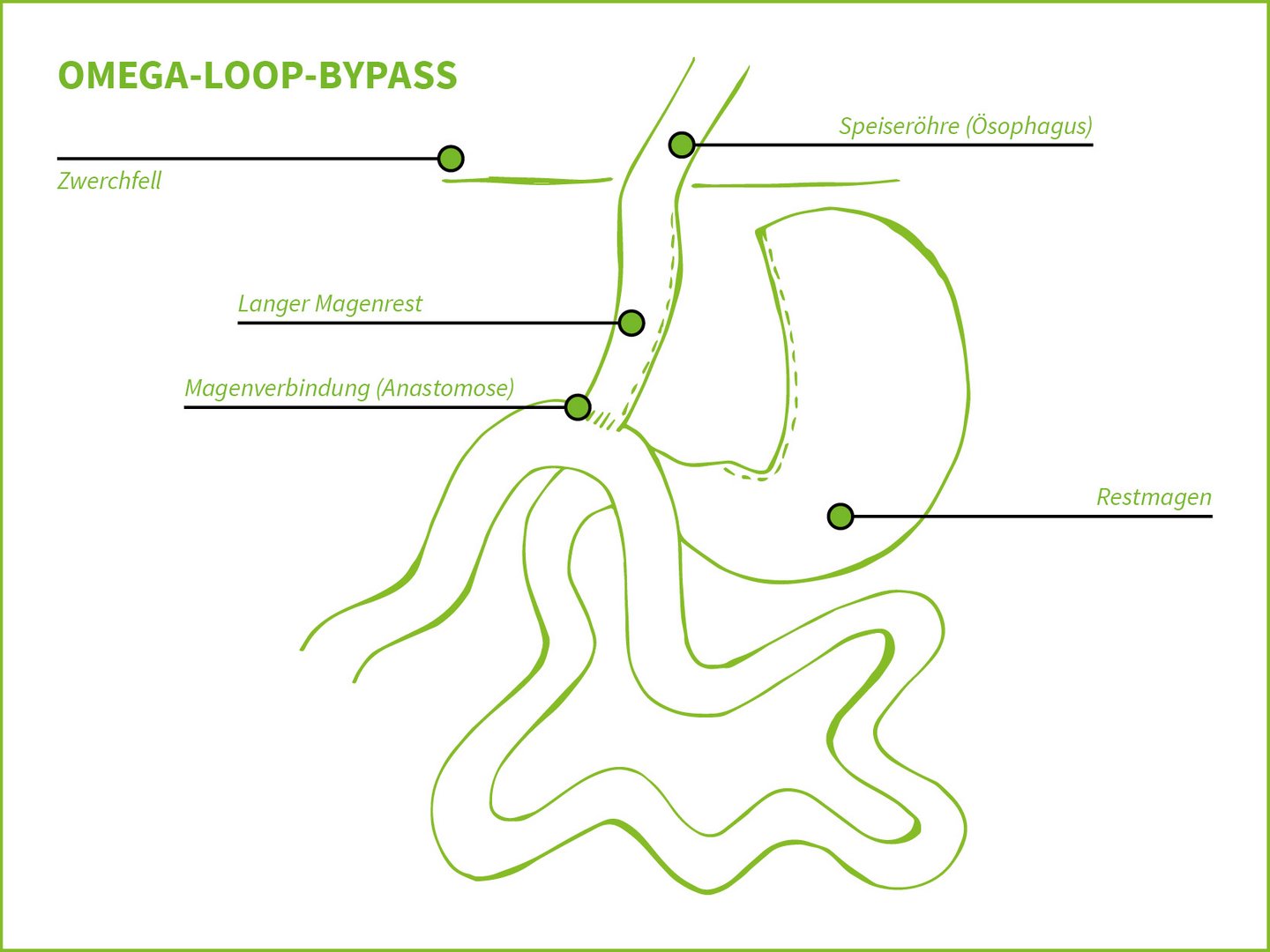 Operative Verfahren - Adipositas-Zentrum: Klinikum Dortmund - Größtes ...