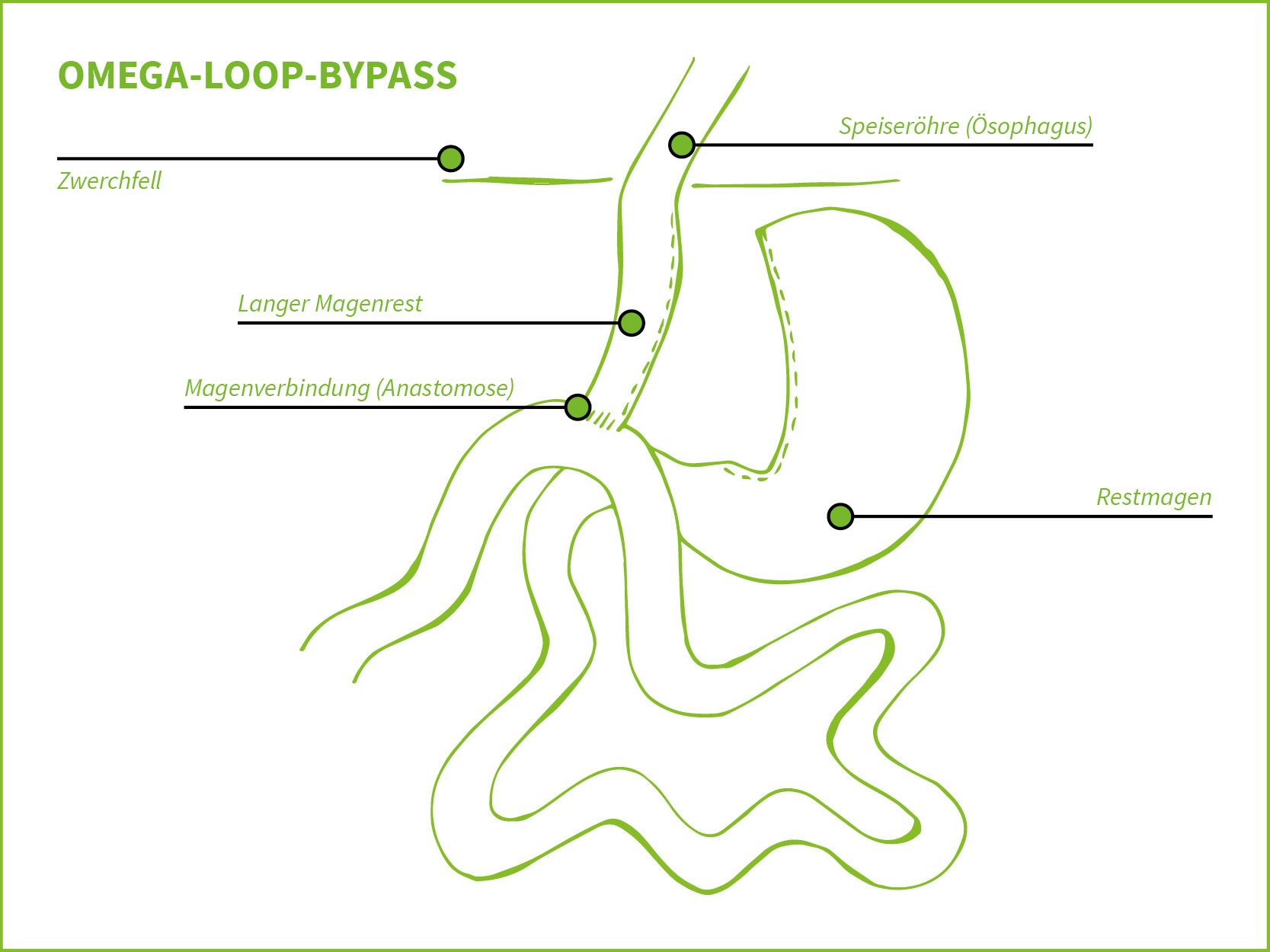 Operative Verfahren - Adipositas-Zentrum: Klinikum Dortmund - Größtes ...